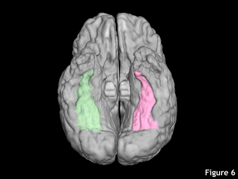 Fusiform Gyrus Coronal