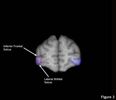 Inferior Frontal Sulcus Radiology